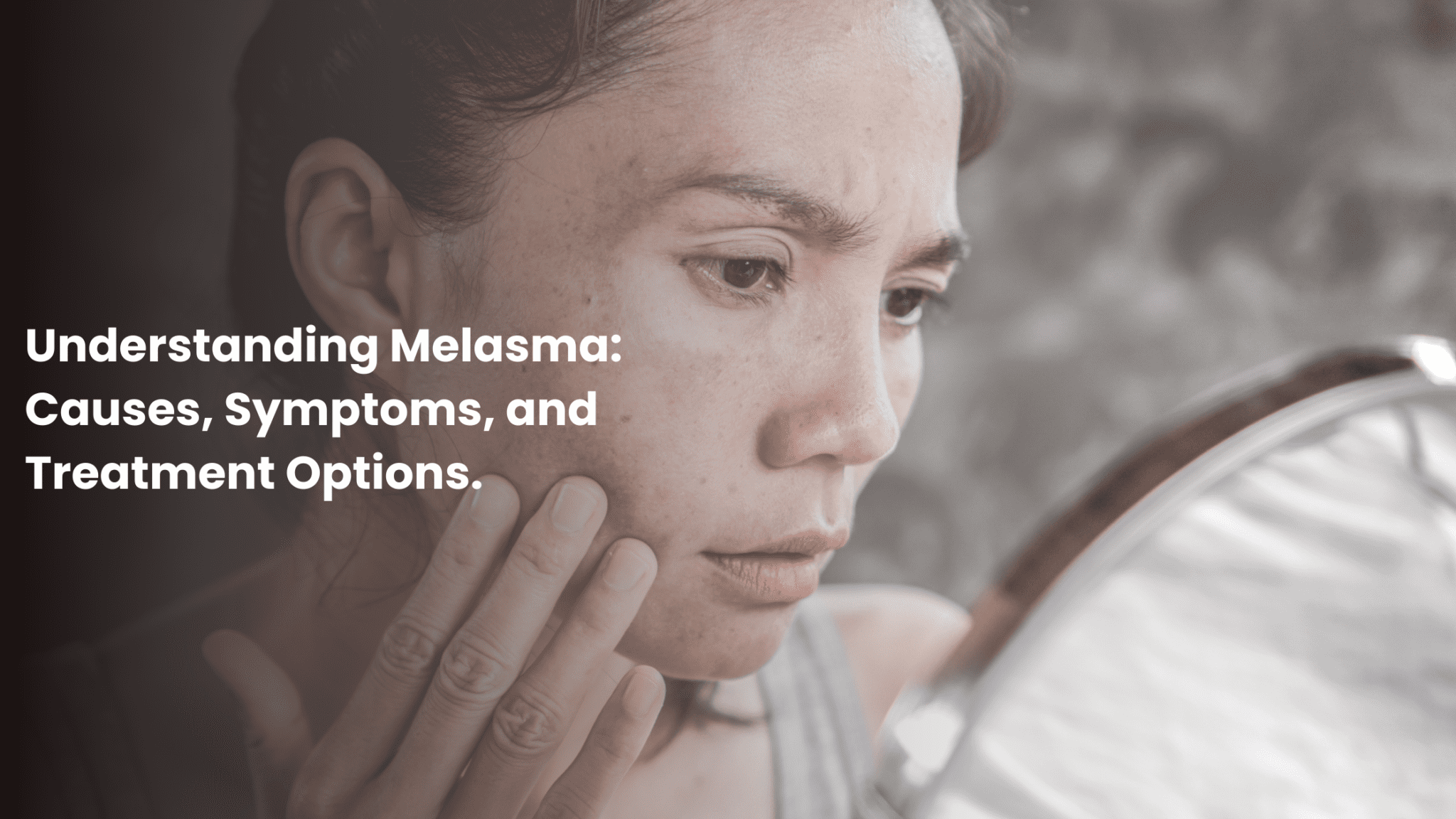 Understanding Melasma: Causes, Symptoms, and Treatment Options ...