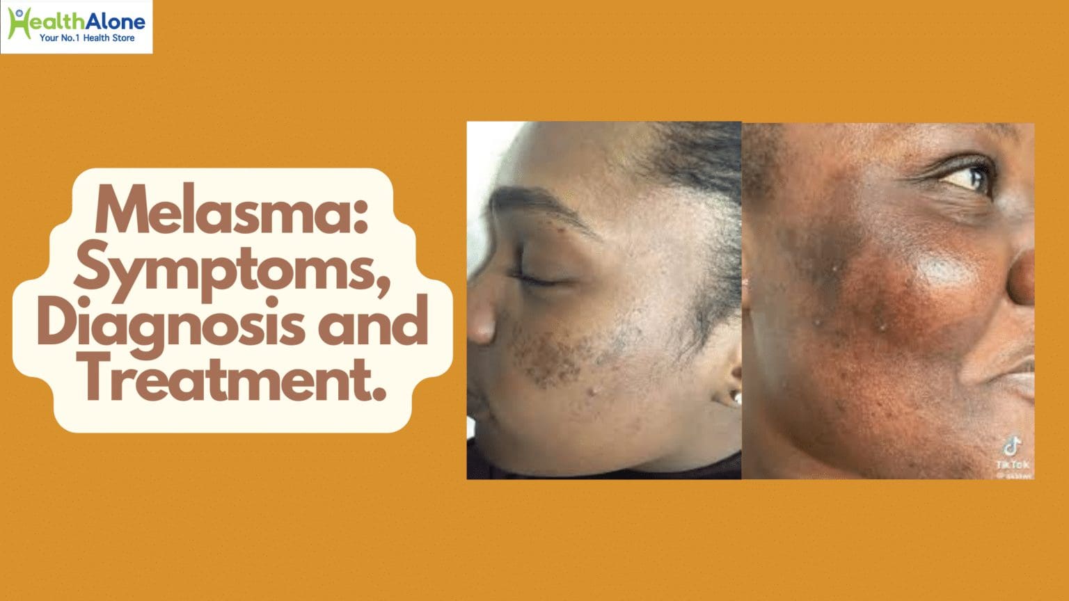Melasma: Symptoms, Diagnosis and Treatment. - Health Alone
